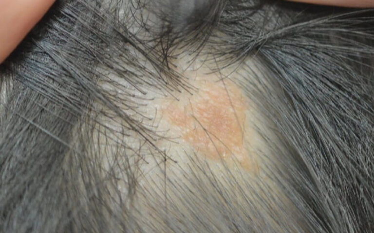 Scalp Problem Treatment in Singapore | Dr Wong Soon Tee