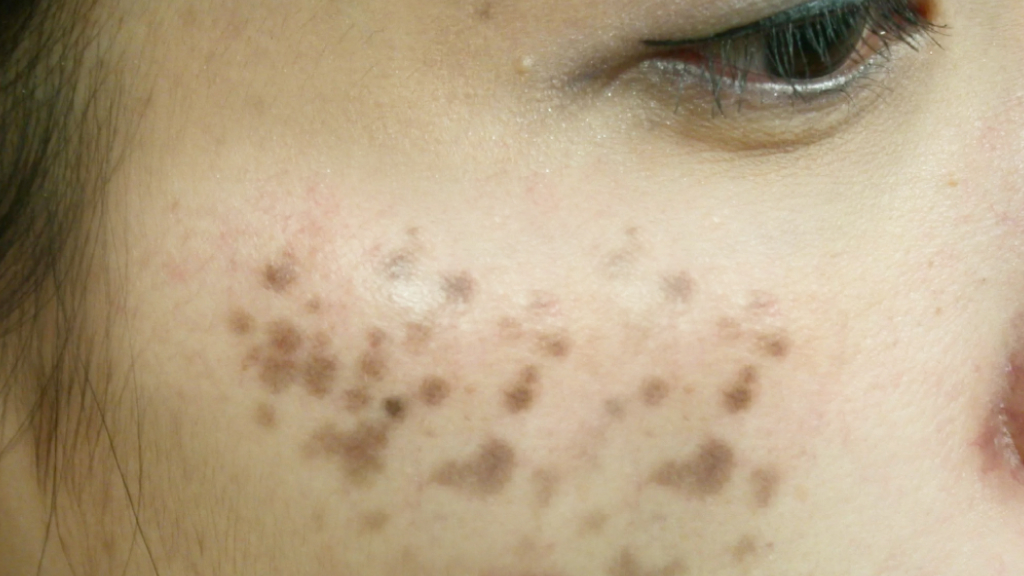 Macule Skin