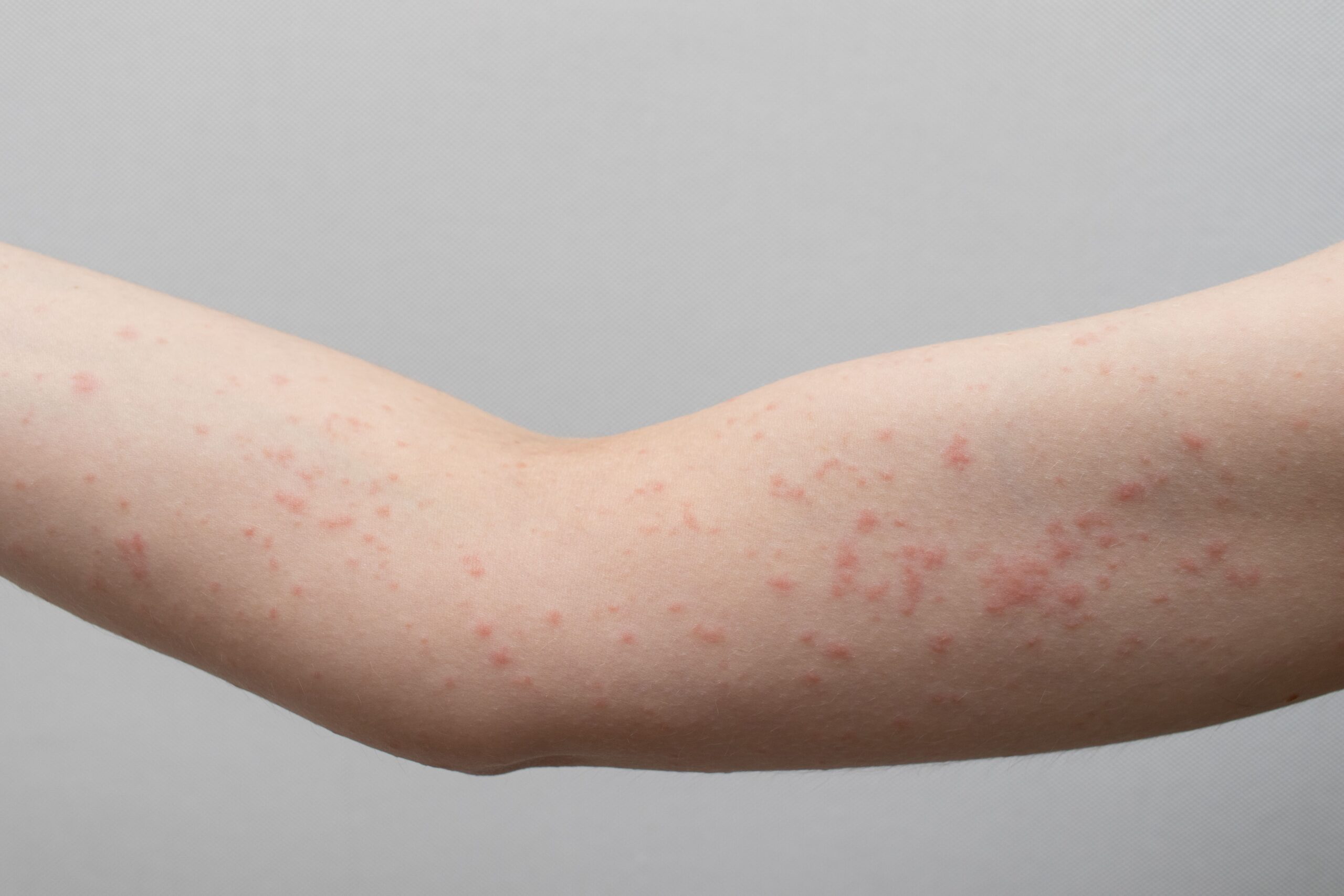 Urticaria Arm Hives: Symptoms, Causes, Prevention And Treatments