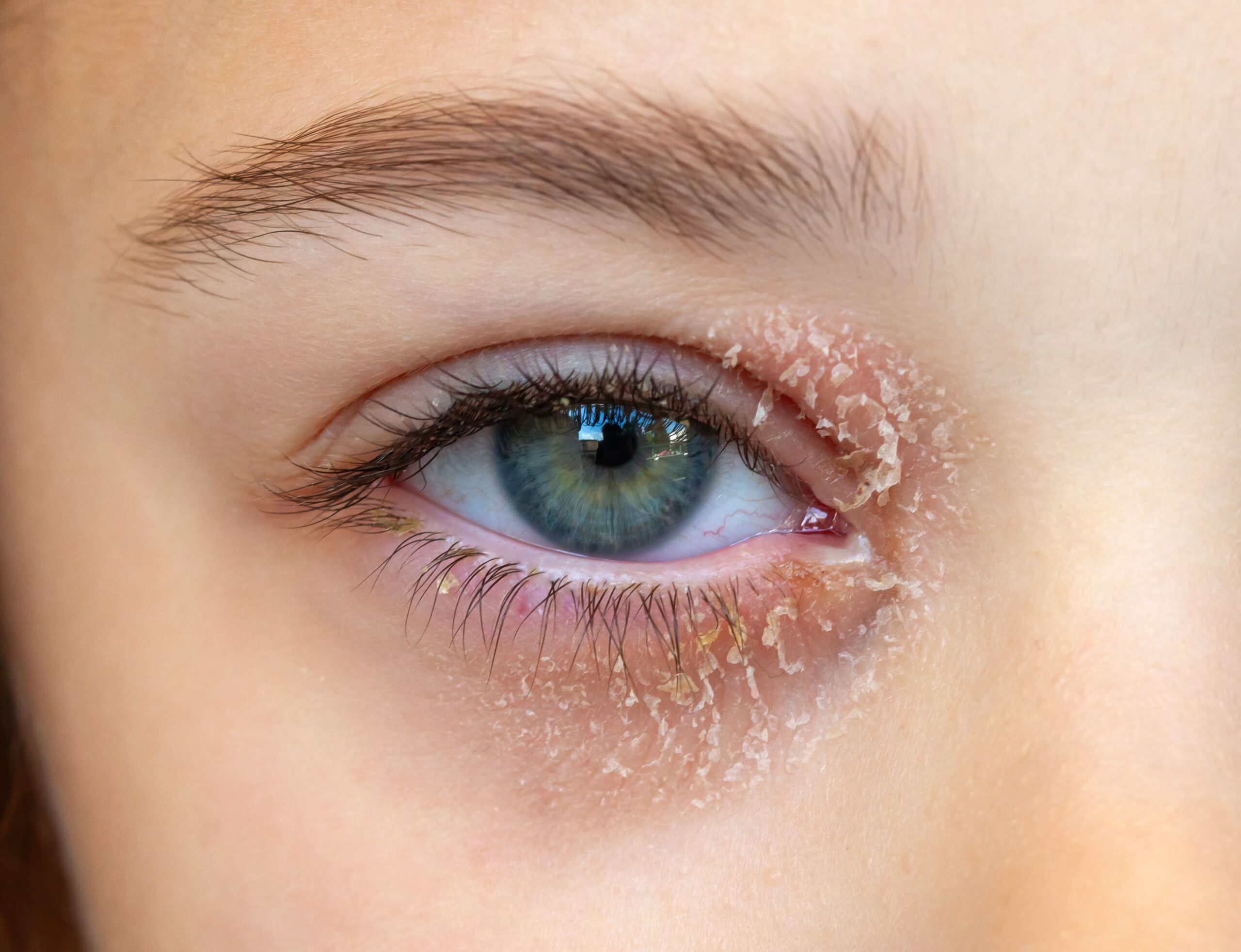 How to Treat Eyelid Eczema - Assurance Skin
