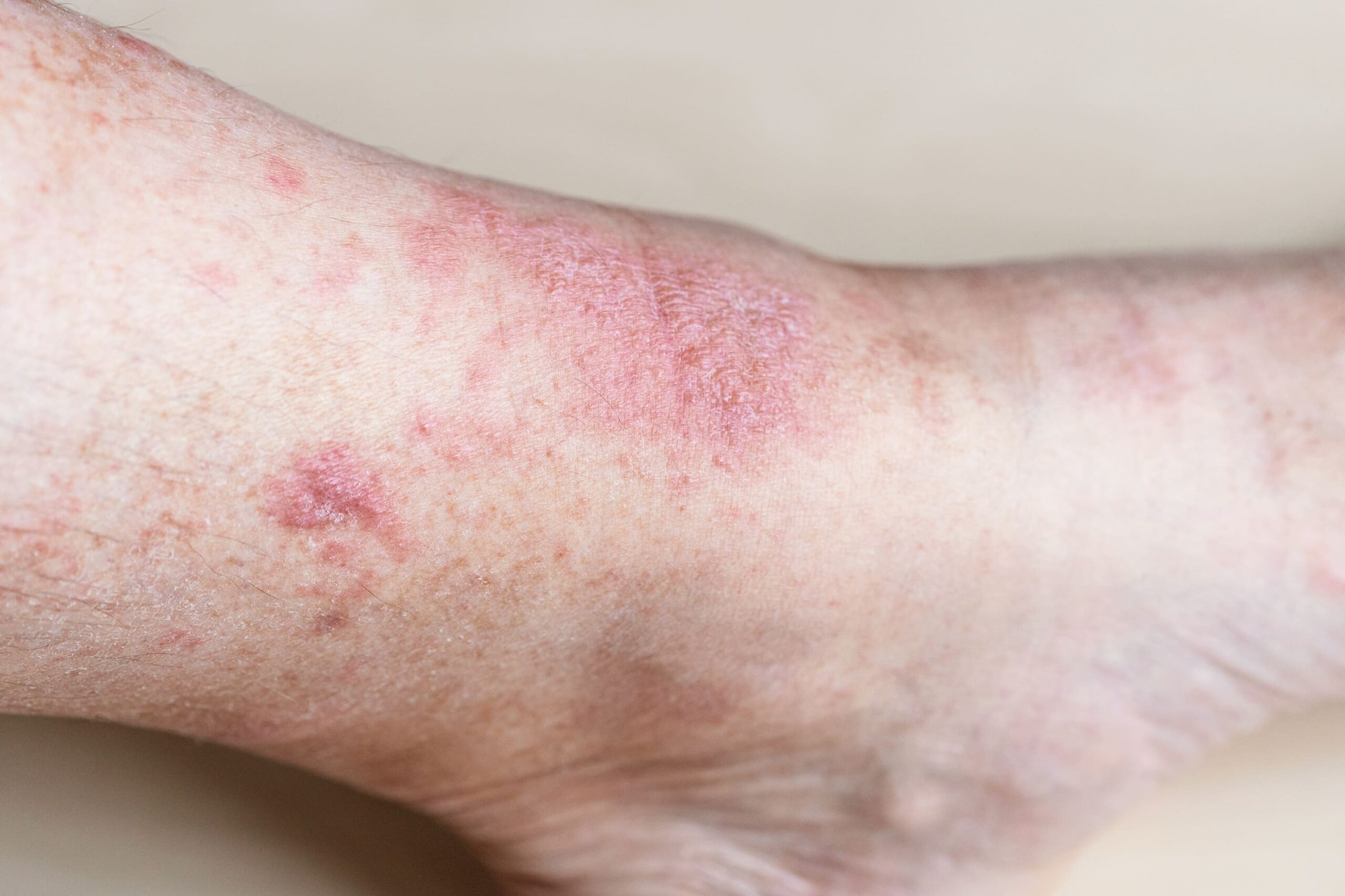 Severe Eczema When To Seek Help Assurance Skin 9385